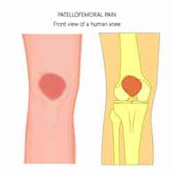 Patellofemoral Pain Syndrome Brisbane | Brisbane North Clinic