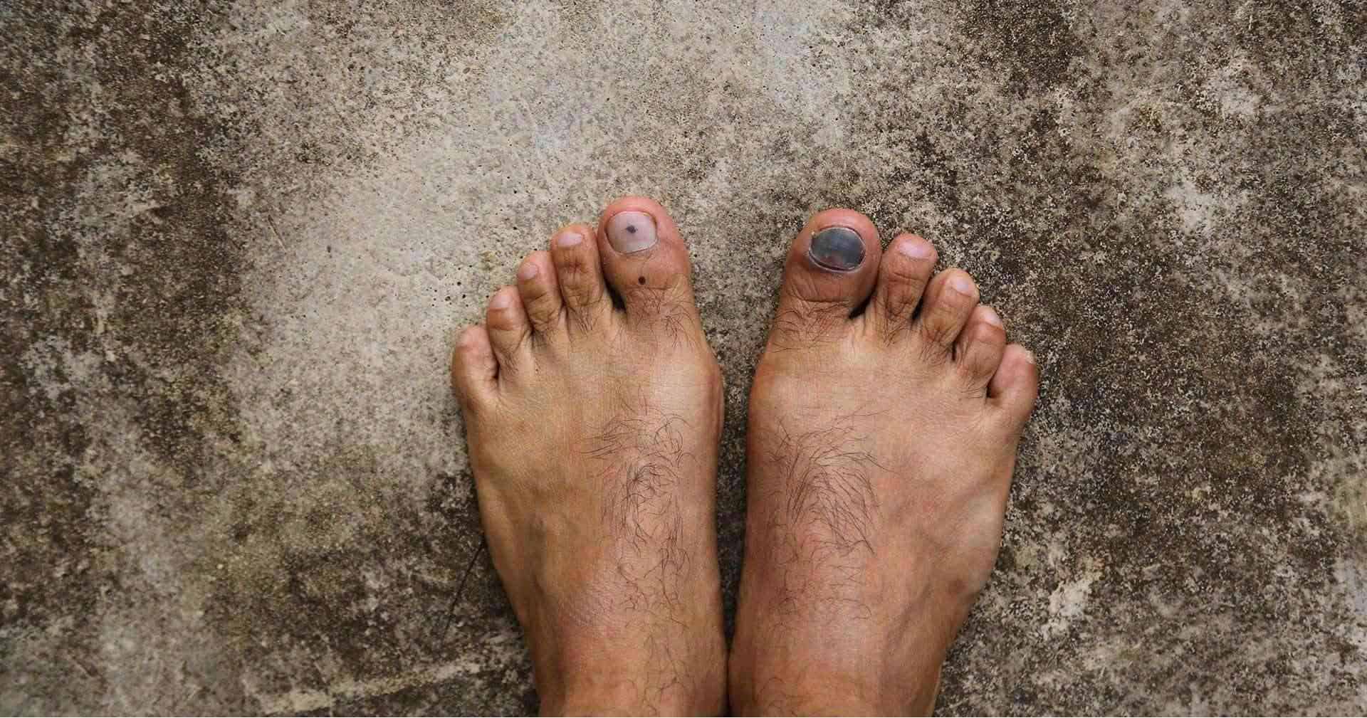 What Is A Black Toenail?
